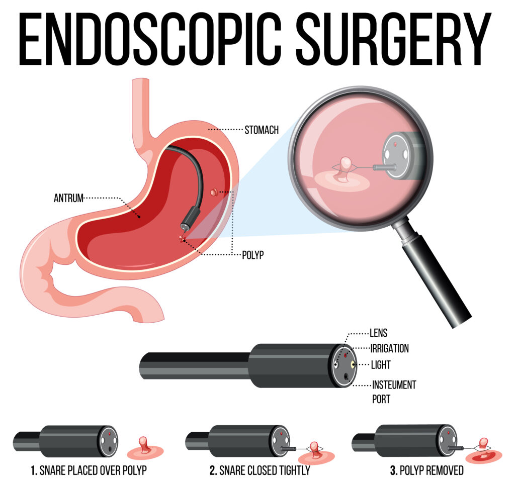 Endoscopy - Eastbay Elite Gastroenterology